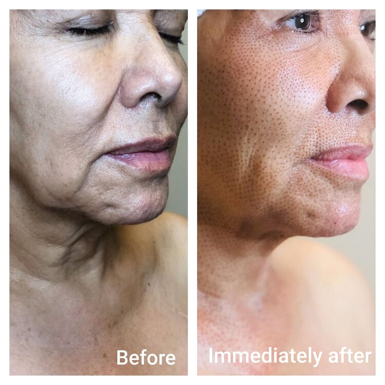 Fractional RF Microneedling – Skin Asylum